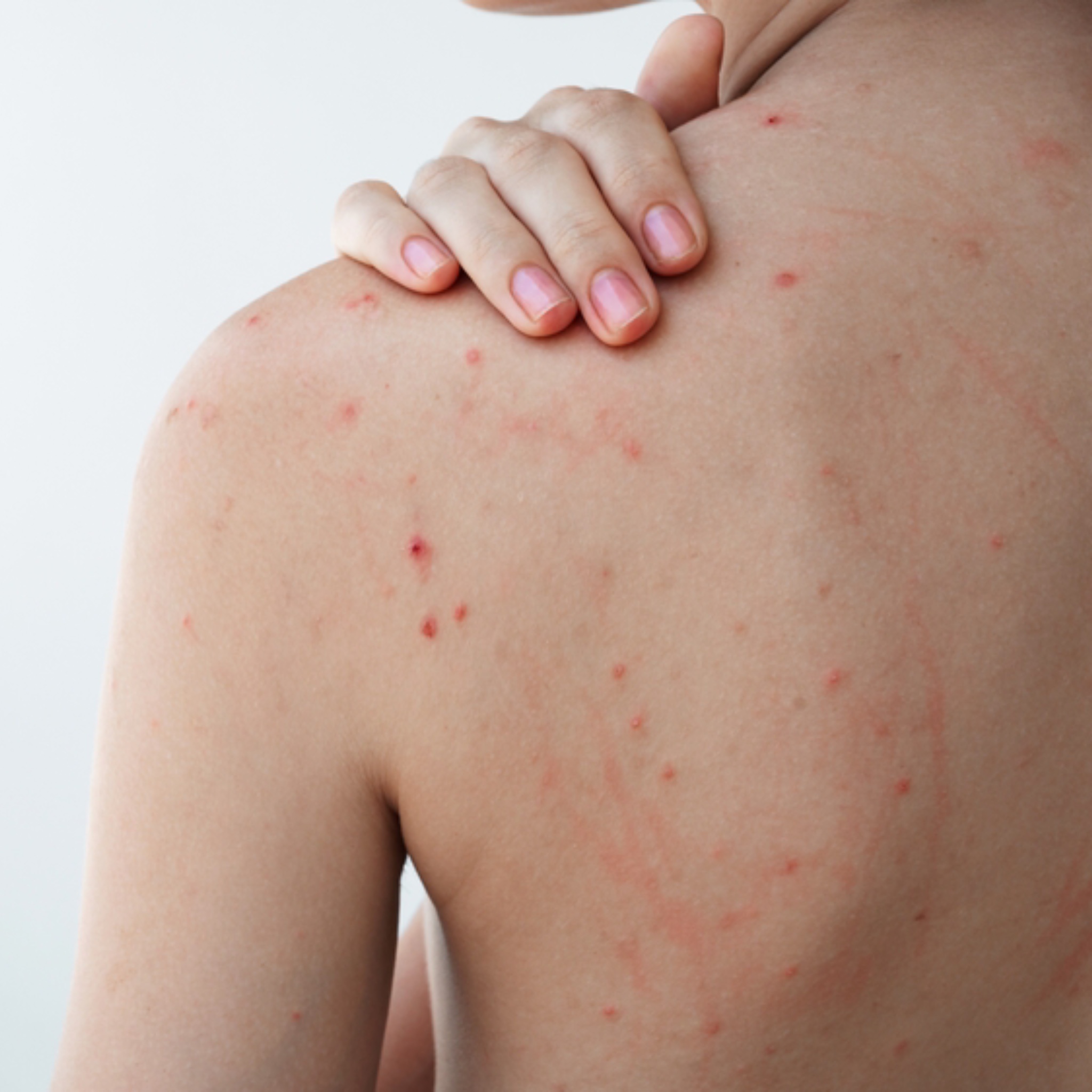 Effektive dybderensende Akne behandlinger hos Your Clinic